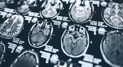 What do MS spasticity and muscle spasms feel like? | MS Trust